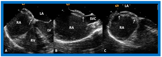 Role of Echocardiography in the Diagnosis and Interventional Management ...