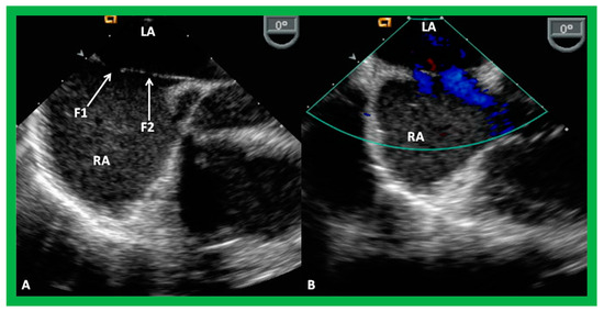 Role of Echocardiography in the Diagnosis and Interventional Management ...