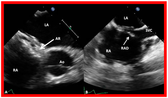 Role of Echocardiography in the Diagnosis and Interventional Management ...