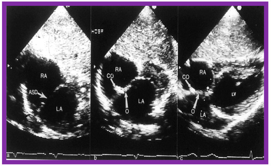 Role of Echocardiography in the Diagnosis and Interventional Management ...