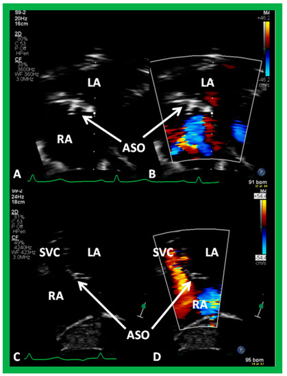 Role of Echocardiography in the Diagnosis and Interventional Management ...
