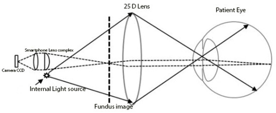 Optics and Utility of Low-Cost Smartphone-Based Portable Digital Fundus ...