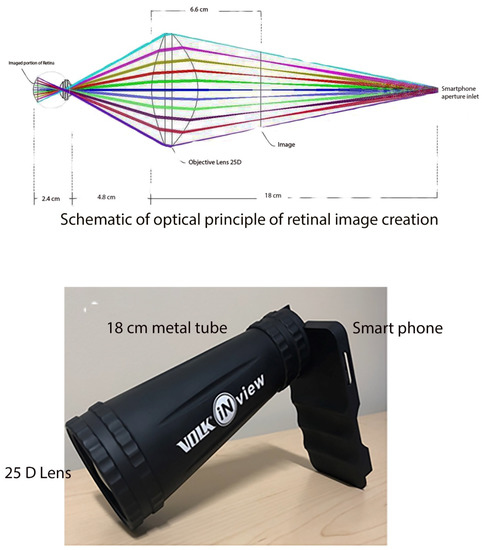 Optics and Utility of Low-Cost Smartphone-Based Portable Digital Fundus ...