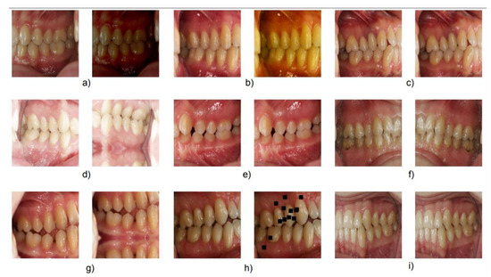 Hyperparameter Tuning and Automatic Image Augmentation for Deep Learning-Based Angle ...