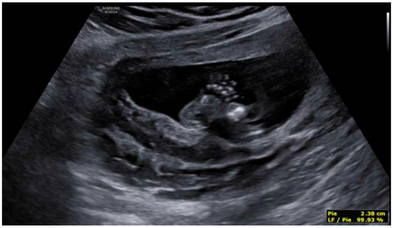 Neu Laxova Syndrome