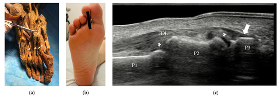High-Resolution Ultrasound of the Forefoot and Common Pathologies