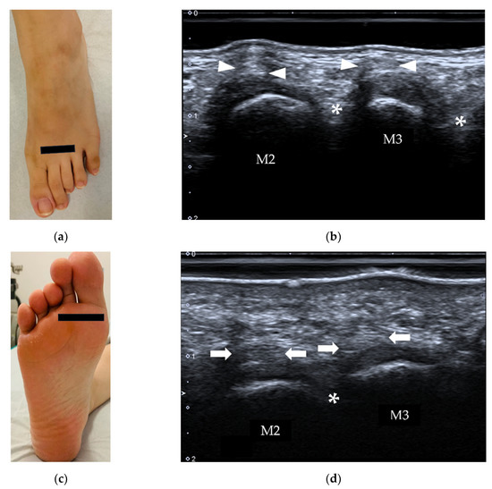 High-Resolution Ultrasound of the Forefoot and Common Pathologies
