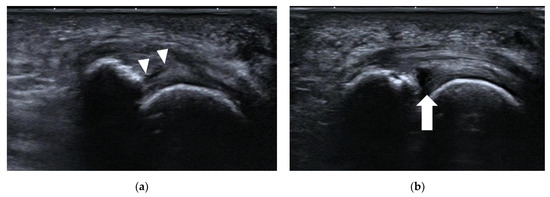 High-Resolution Ultrasound of the Forefoot and Common Pathologies