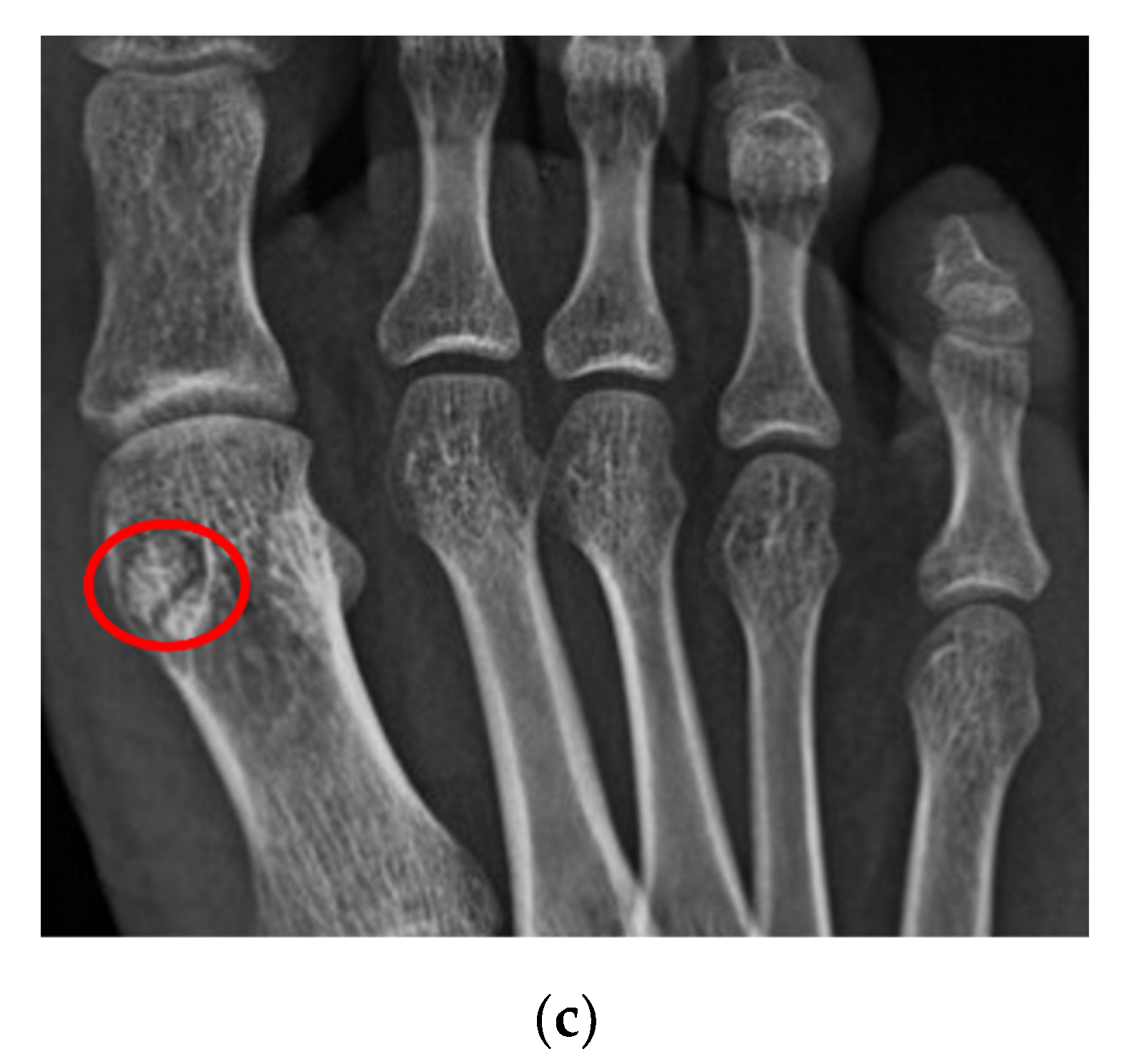 Diagnostics Free Full Text High Resolution Ultrasound Of The Forefoot And Common Pathologies