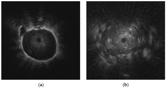 Pulmonary Lesion Classification Framework Using the Weighted Ensemble ...