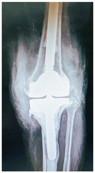 Fungal Prosthetic Joint Infection in Revised Knee Arthroplasty: An ...
