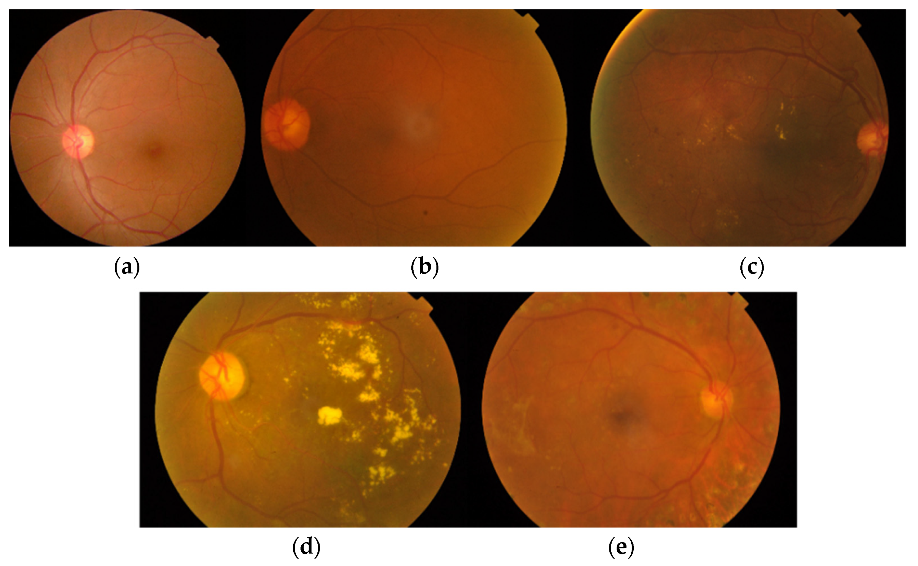 Diabetic Retinopathy Detection from Fundus Images of the Eye Using ...