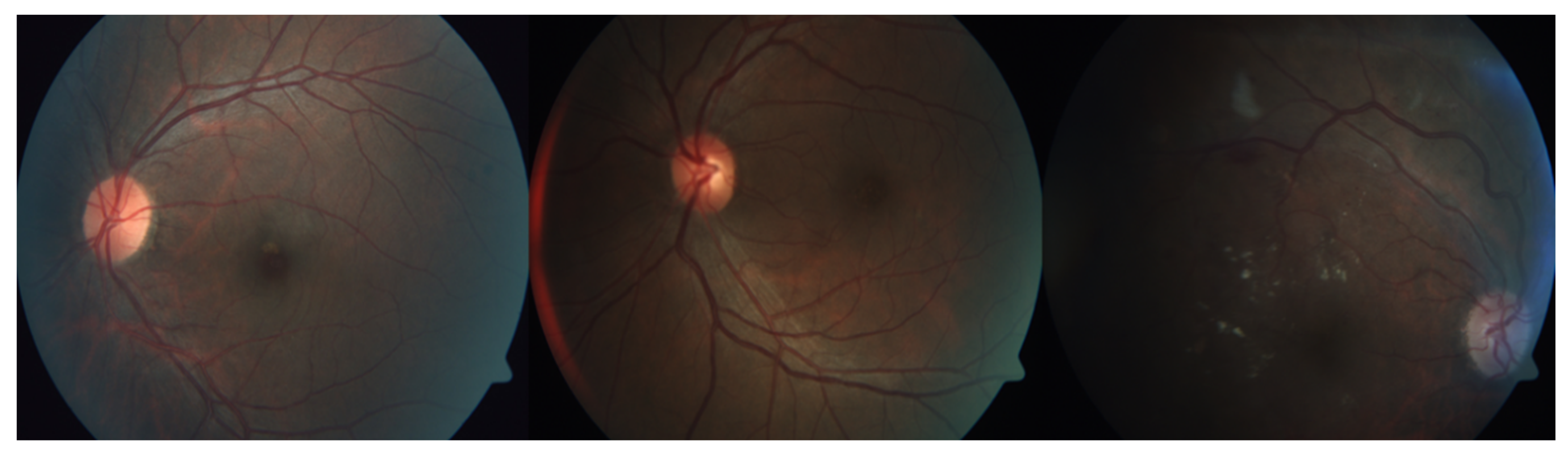 Diabetic Retinopathy Detection from Fundus Images of the Eye Using ...