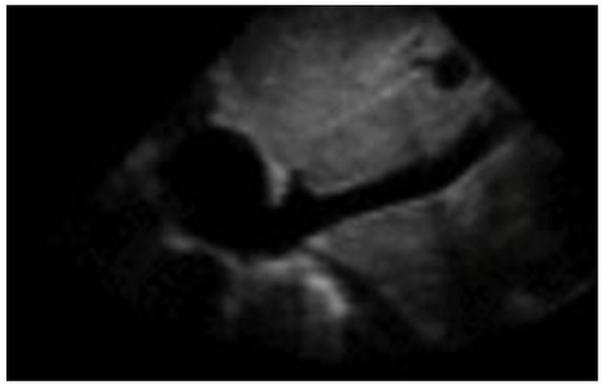Use of POCUS in Chest Pain and Dyspnea in Emergency Department: What ...