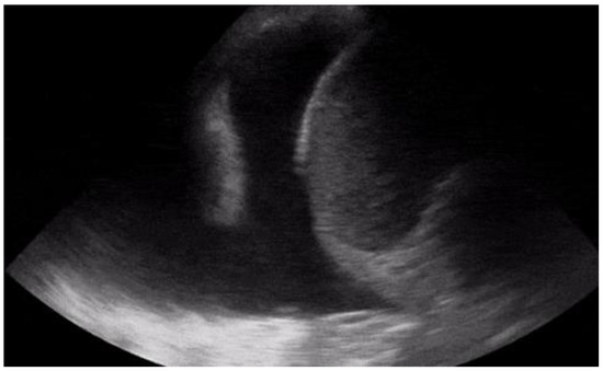 Use of POCUS in Chest Pain and Dyspnea in Emergency Department: What ...