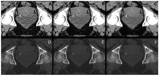 Influence of a Deep Learning Noise Reduction on the CT Values, Image ...