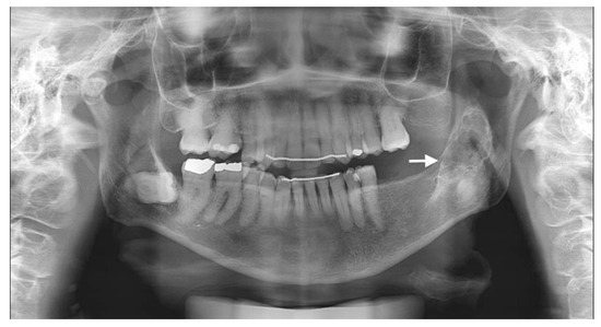 Mandibular Radiolucencies: A Differential Diagnosis of a Rare Tumor
