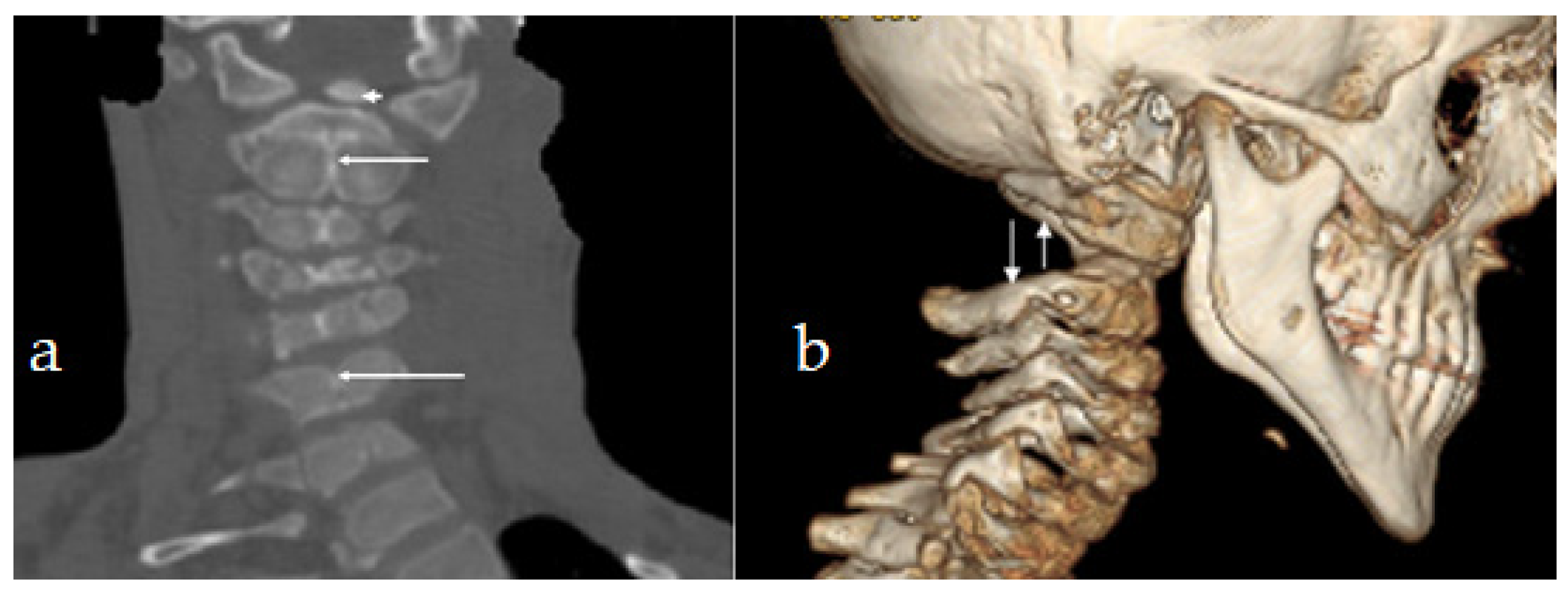Torticollis in Connection with Spine Phenotype
