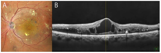 Progress of Imaging in Diabetic Retinopathy—From the Past to the Present