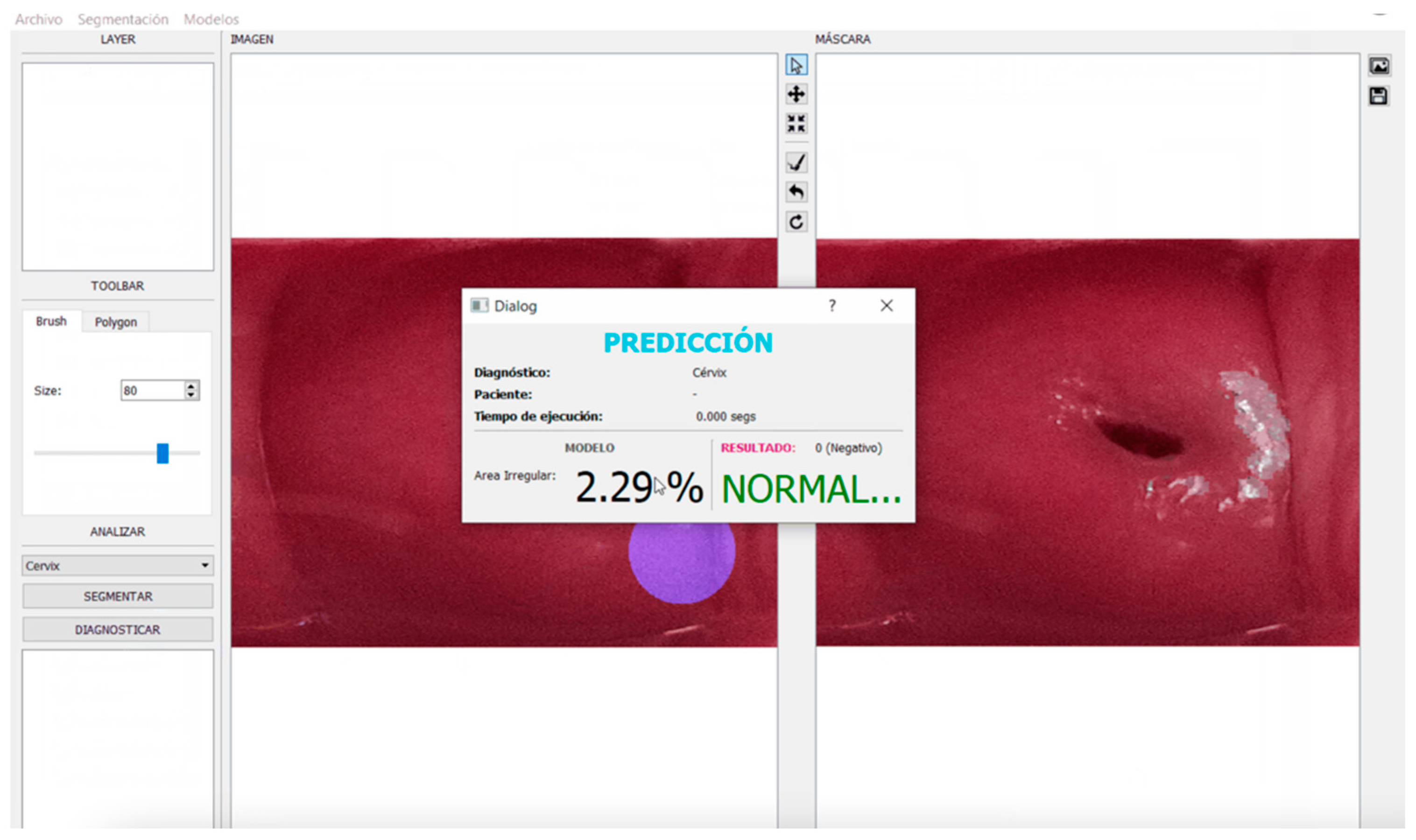 Radiomics Diagnostic Tool Based on Deep Learning for Colposcopy Image ...