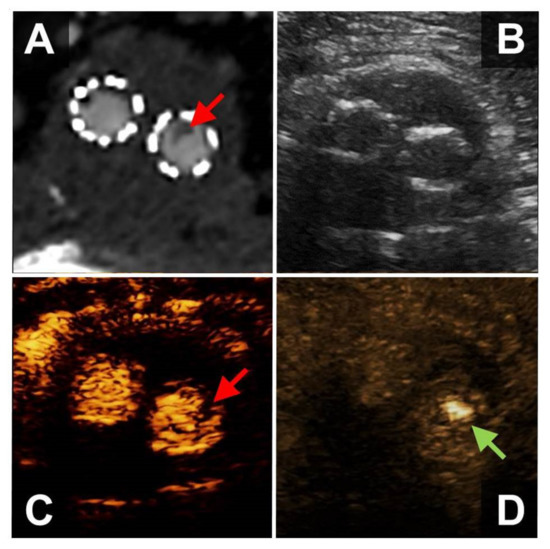 The Flashlight-Sign: A Novel B-Flow Based Ultrasound Finding for ...