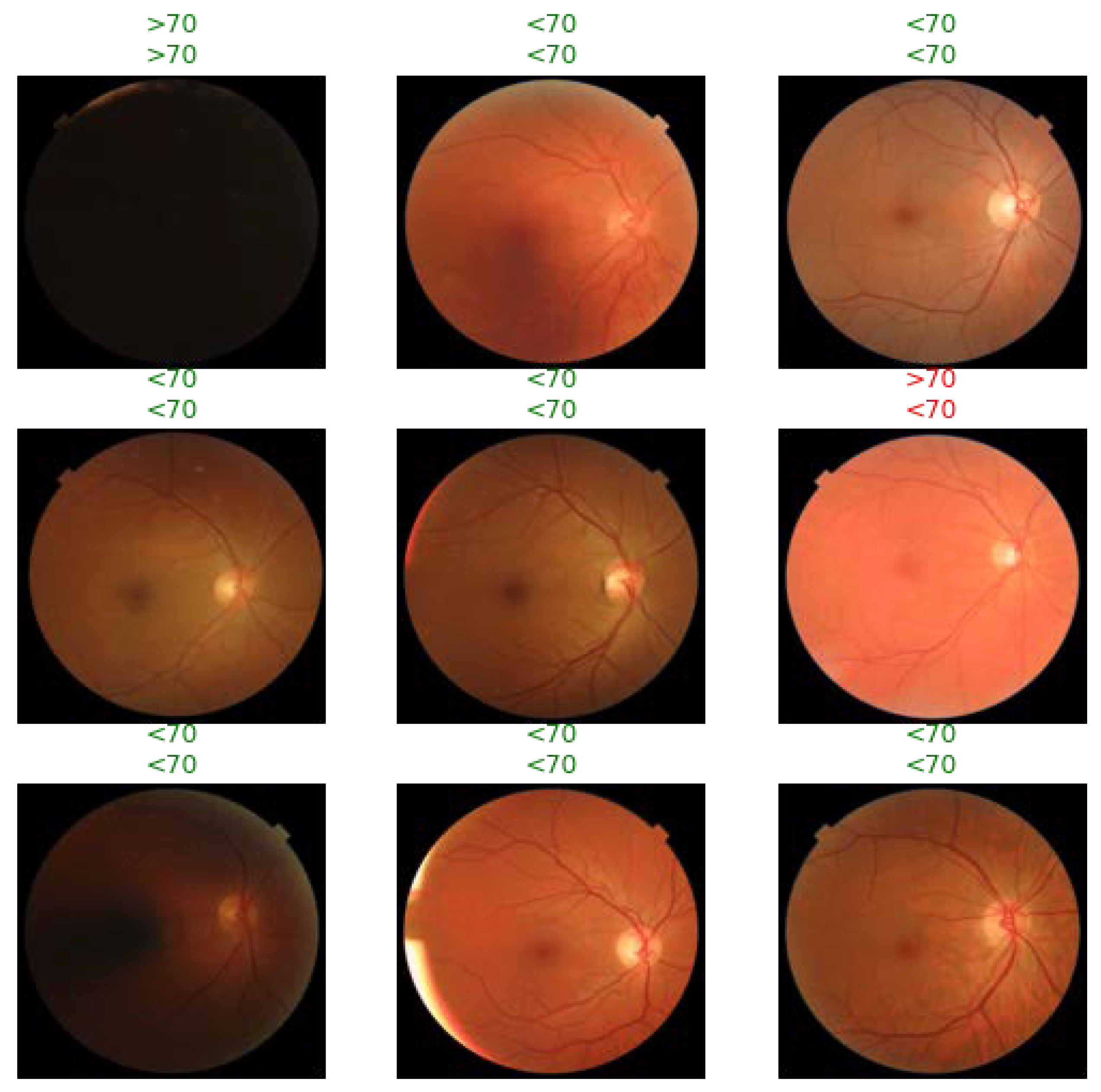 Predicting Systemic Health Features From Retinal Fundus Images Using Transfer Learning Based 7916