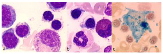 When Ring Sideroblasts on Bone Marrow Smears Are Inconsistent with the ...