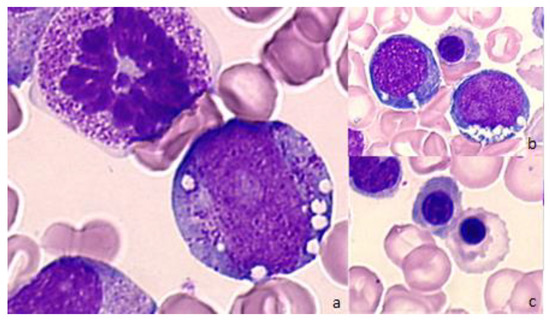 When Ring Sideroblasts on Bone Marrow Smears Are Inconsistent with the ...