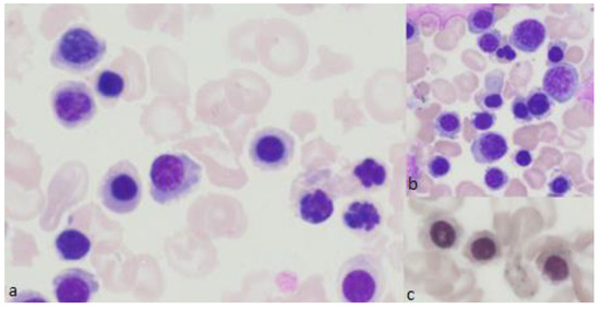 When Ring Sideroblasts on Bone Marrow Smears Are Inconsistent with the Diagnosis of ...