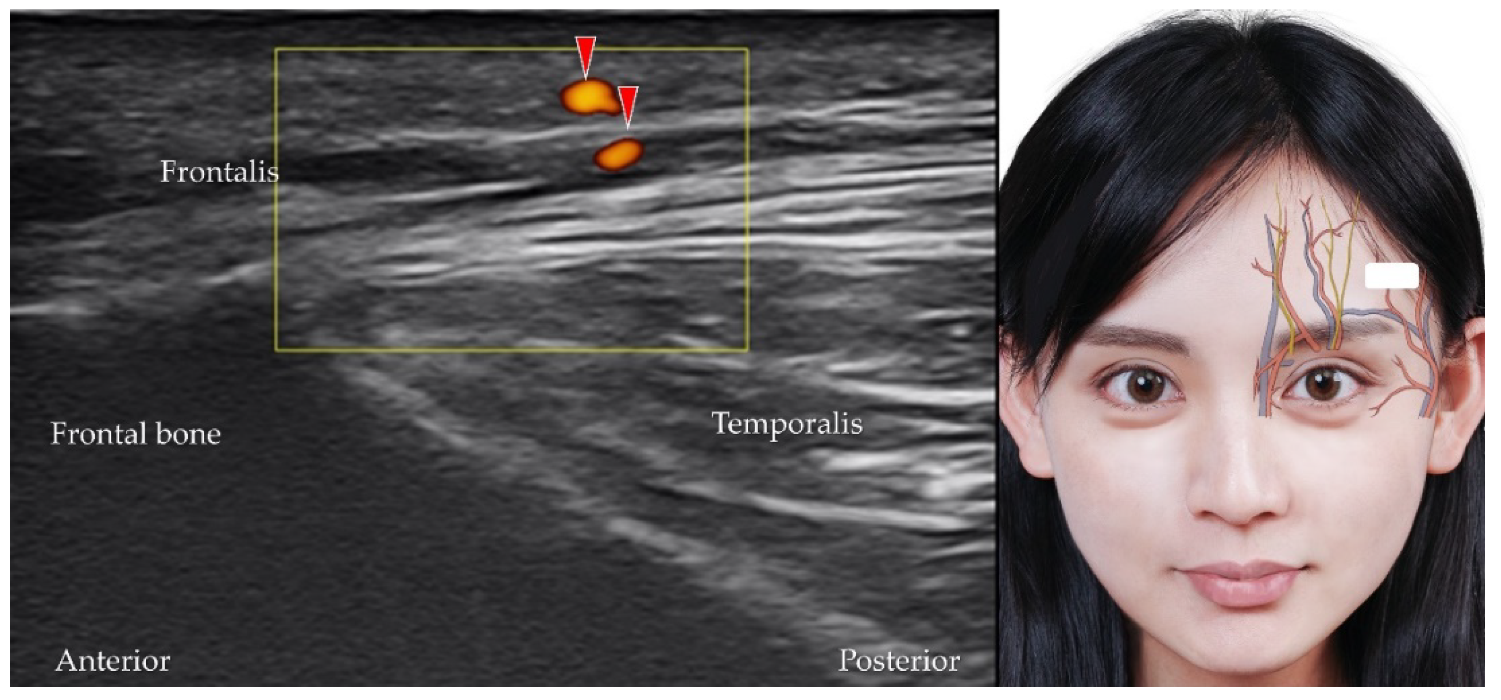Ultrasound Imaging of Facial Vascular Neural Structures and Relevance ...
