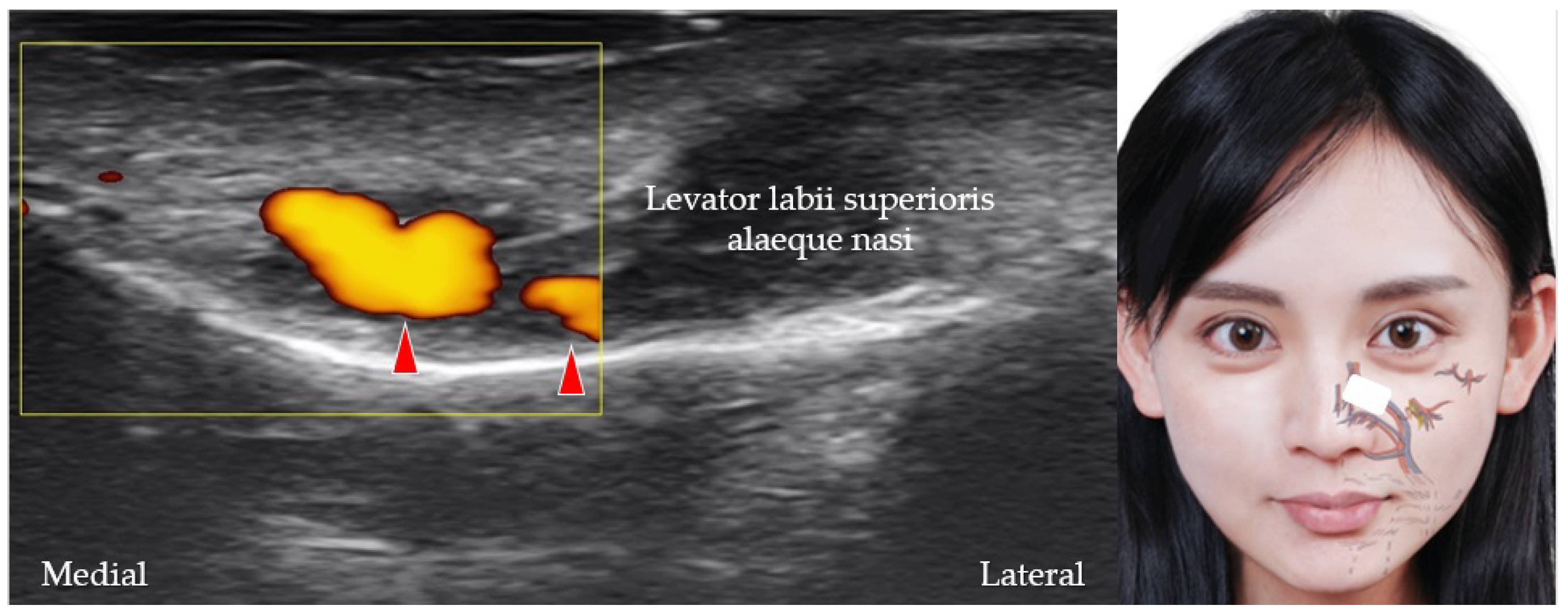 Ultrasound Imaging of Facial Vascular Neural Structures and Relevance ...