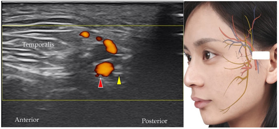 Ultrasound Imaging of Facial Vascular Neural Structures and Relevance ...