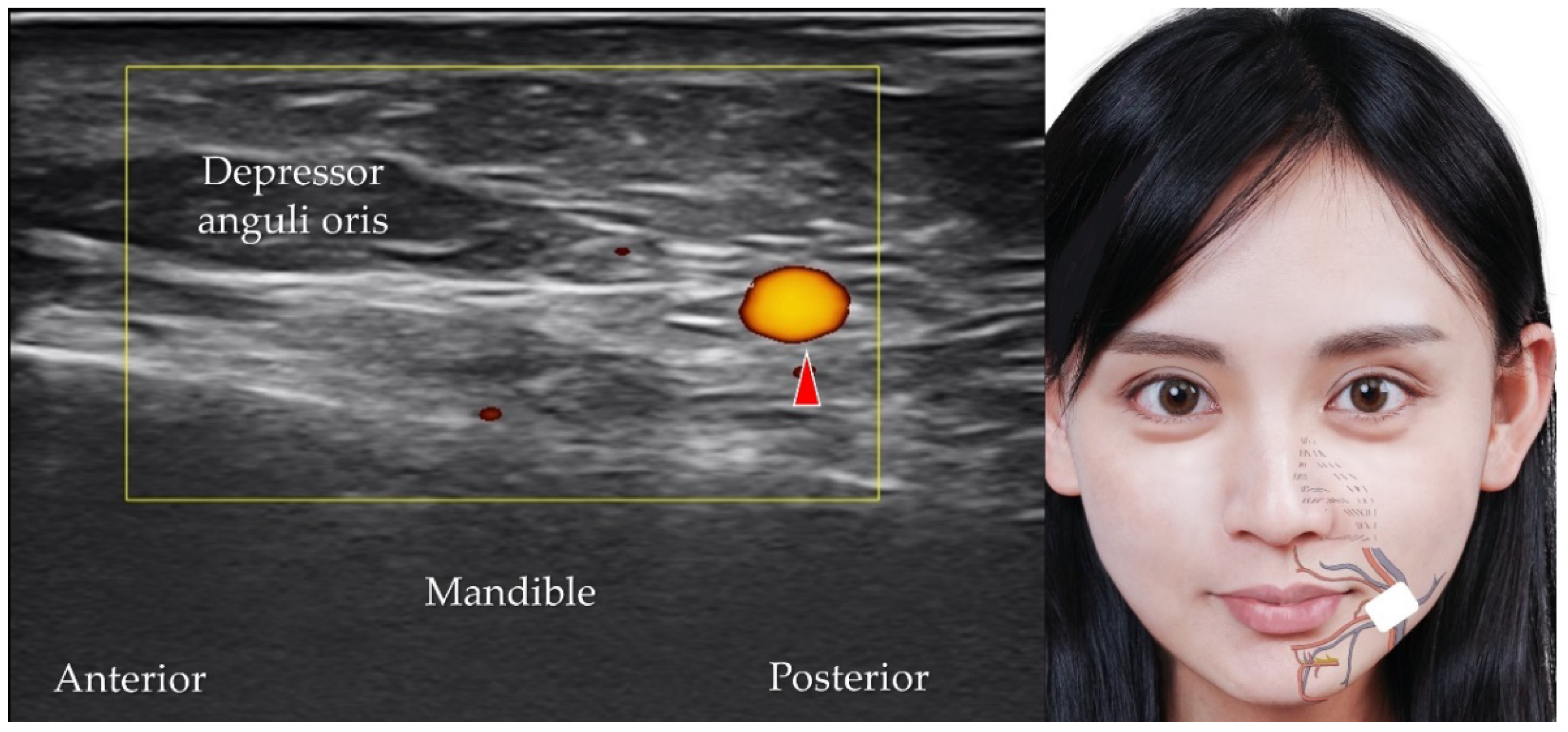 Ultrasound Imaging of Facial Vascular Neural Structures and Relevance ...