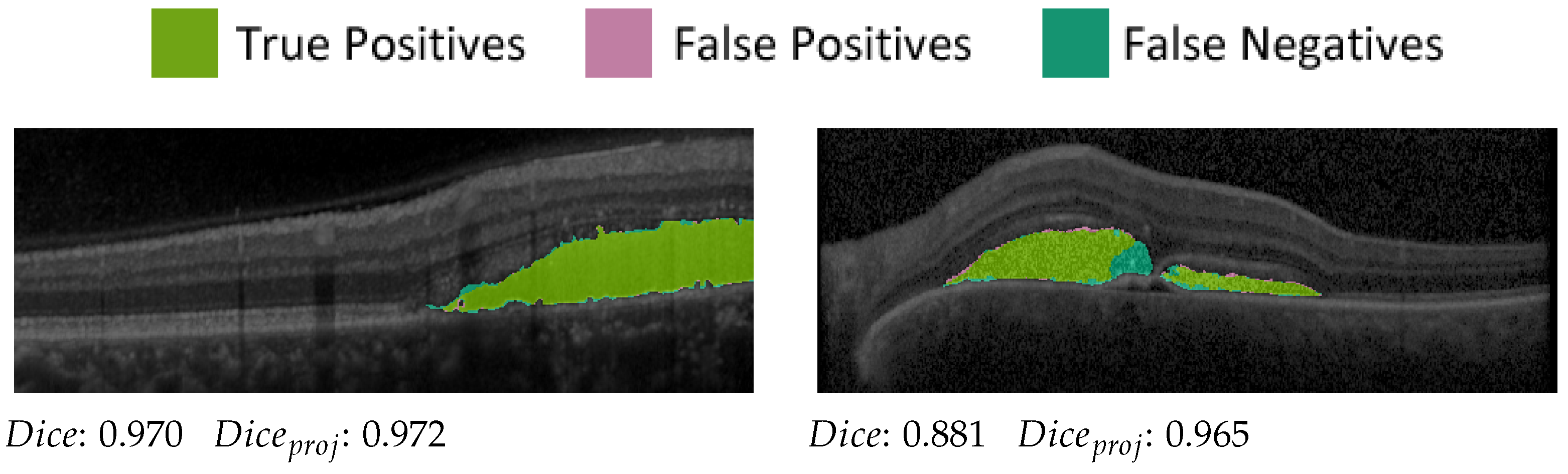 Chronological Registration of OCT and Autofluorescence Findings in CSCR ...