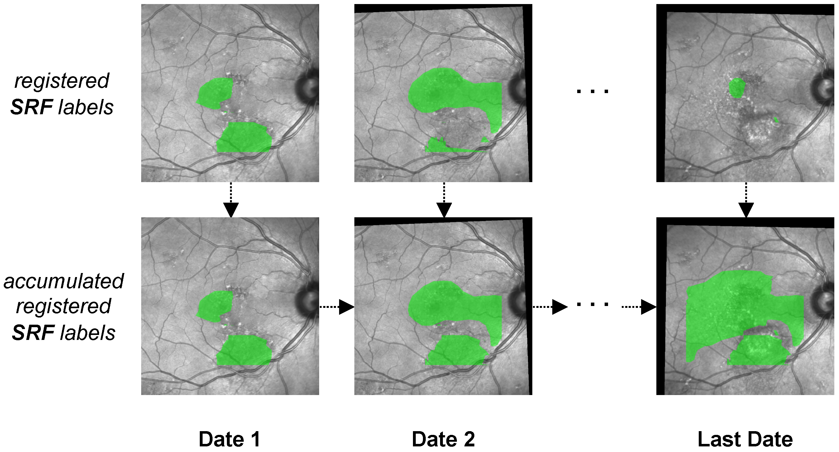 Chronological Registration of OCT and Autofluorescence Findings in CSCR ...
