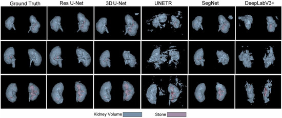 Deep Segmentation Networks for Segmenting Kidneys and Detecting Kidney Stones in Unenhanced ...