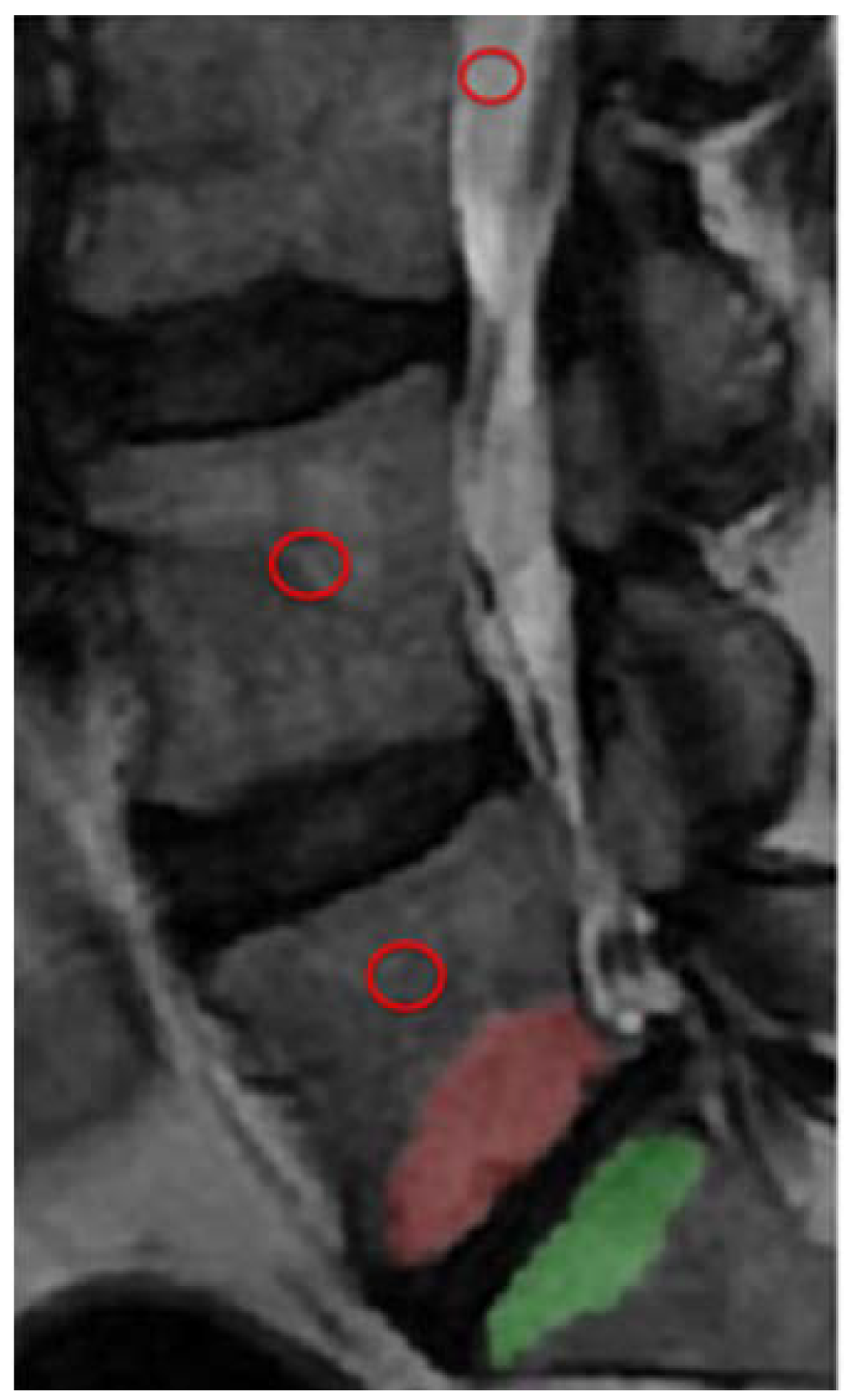 Loading of the Spine in Low Back Pain Patients Does Not Induce MRI ...