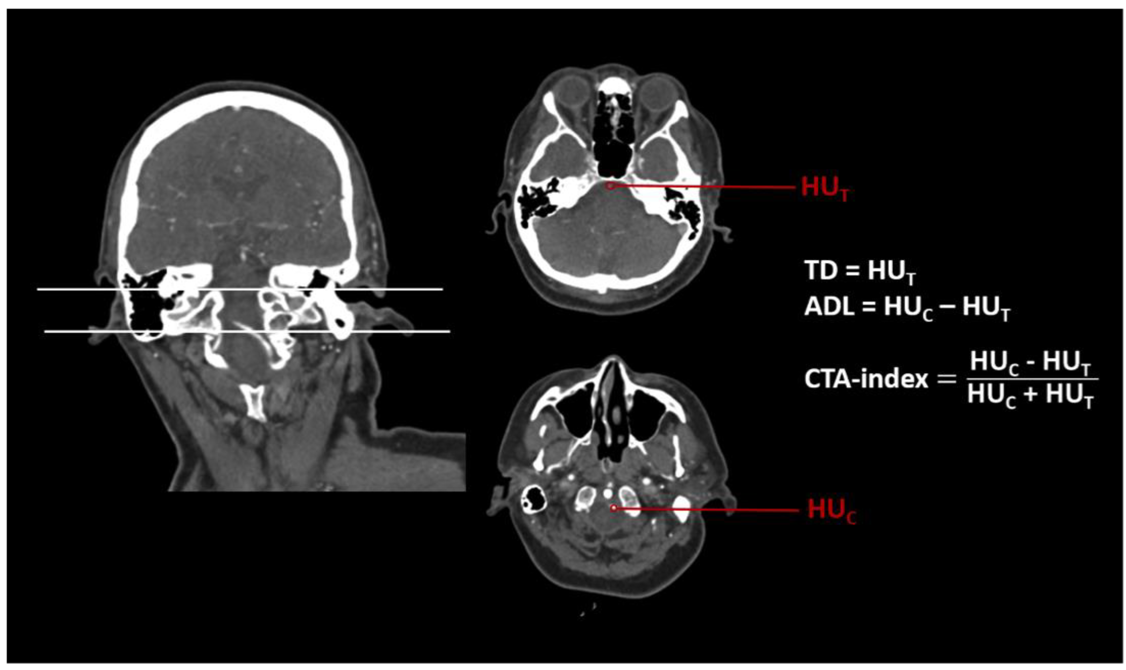 Diagnostics | Free Full-Text | CT Marker in Emergency Imaging of Acute ...