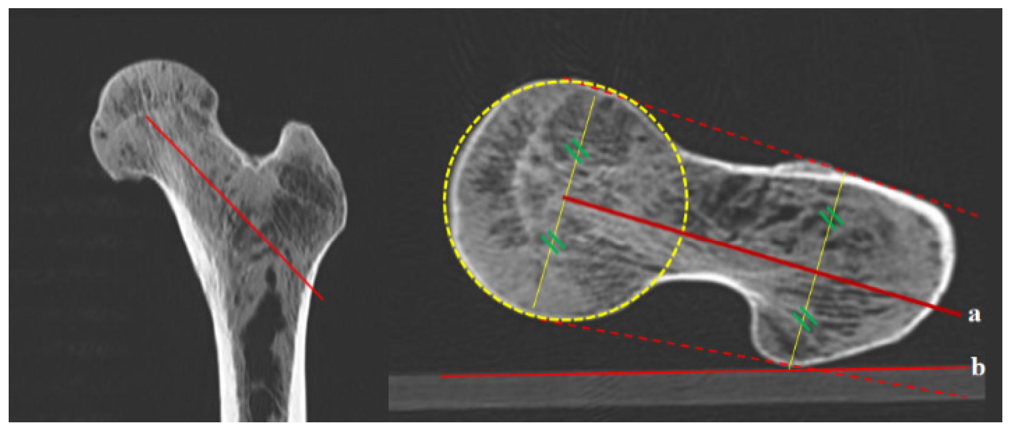 Diagnostics | Free Full-Text | Using the Axial Oblique View of Computed ...