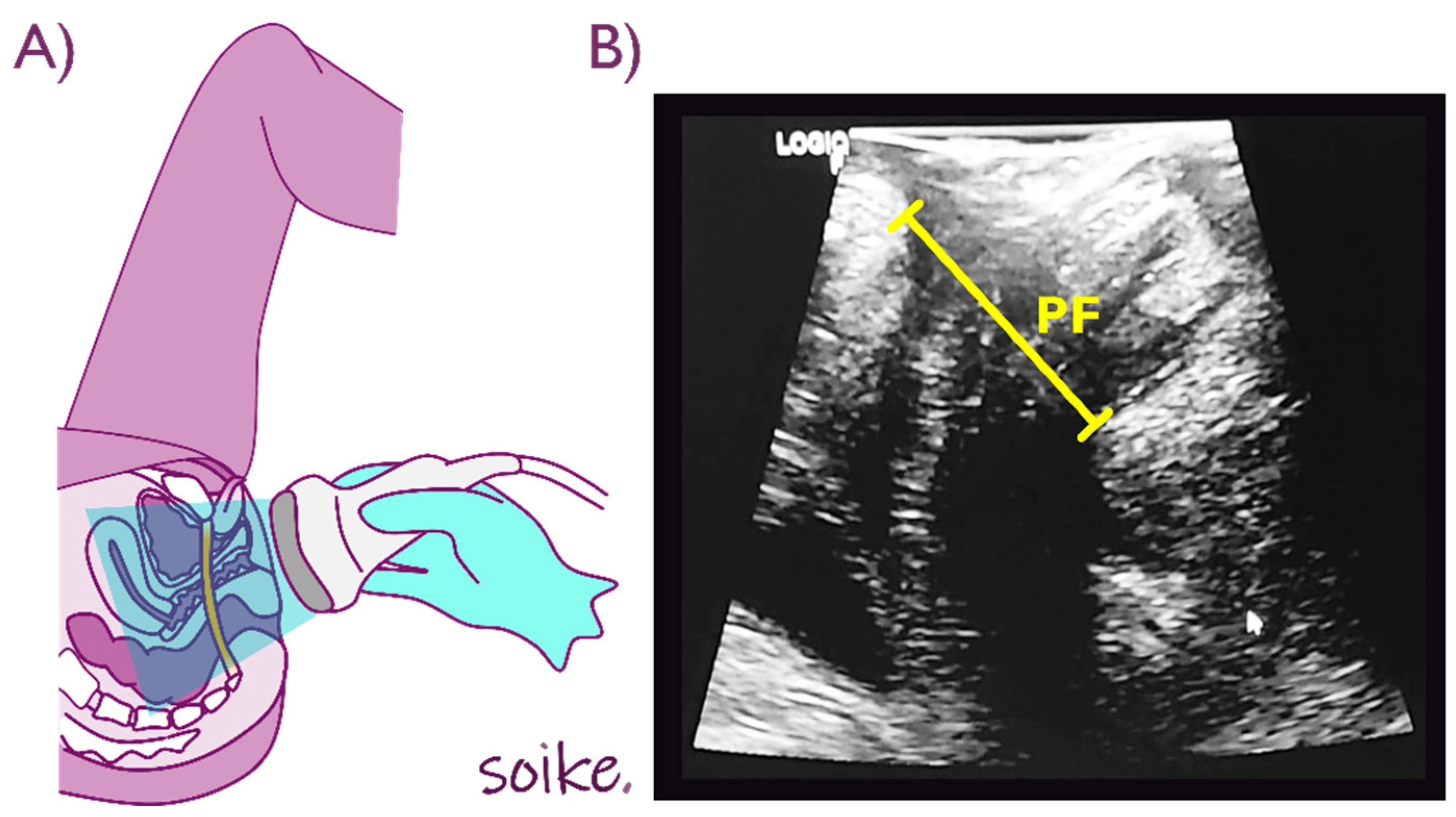 Diagnostics | Free Full-Text | Ultrasonography Comparison of Pelvic ... Diagnostics | Free Full-Text | Ultrasonography Comparison of Pelvic ...