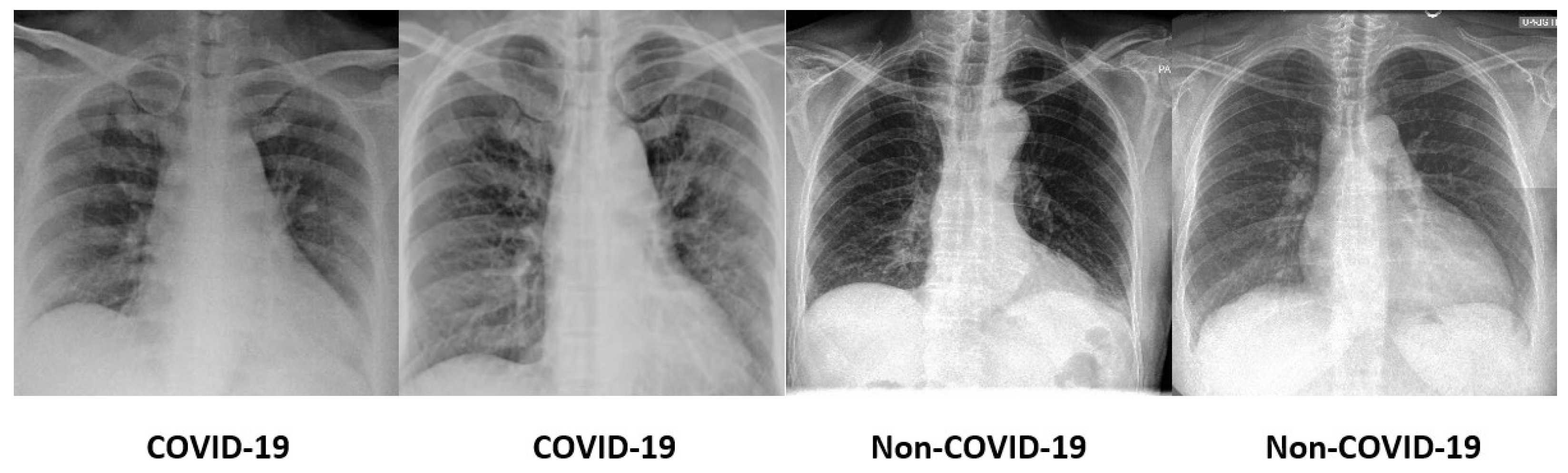 COVID-19 Diagnosis on Chest Radiographs with Enhanced Deep Neural Networks
