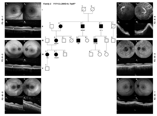 Multimodal Study of PRPH2 Gene-Related Retinal Phenotypes
