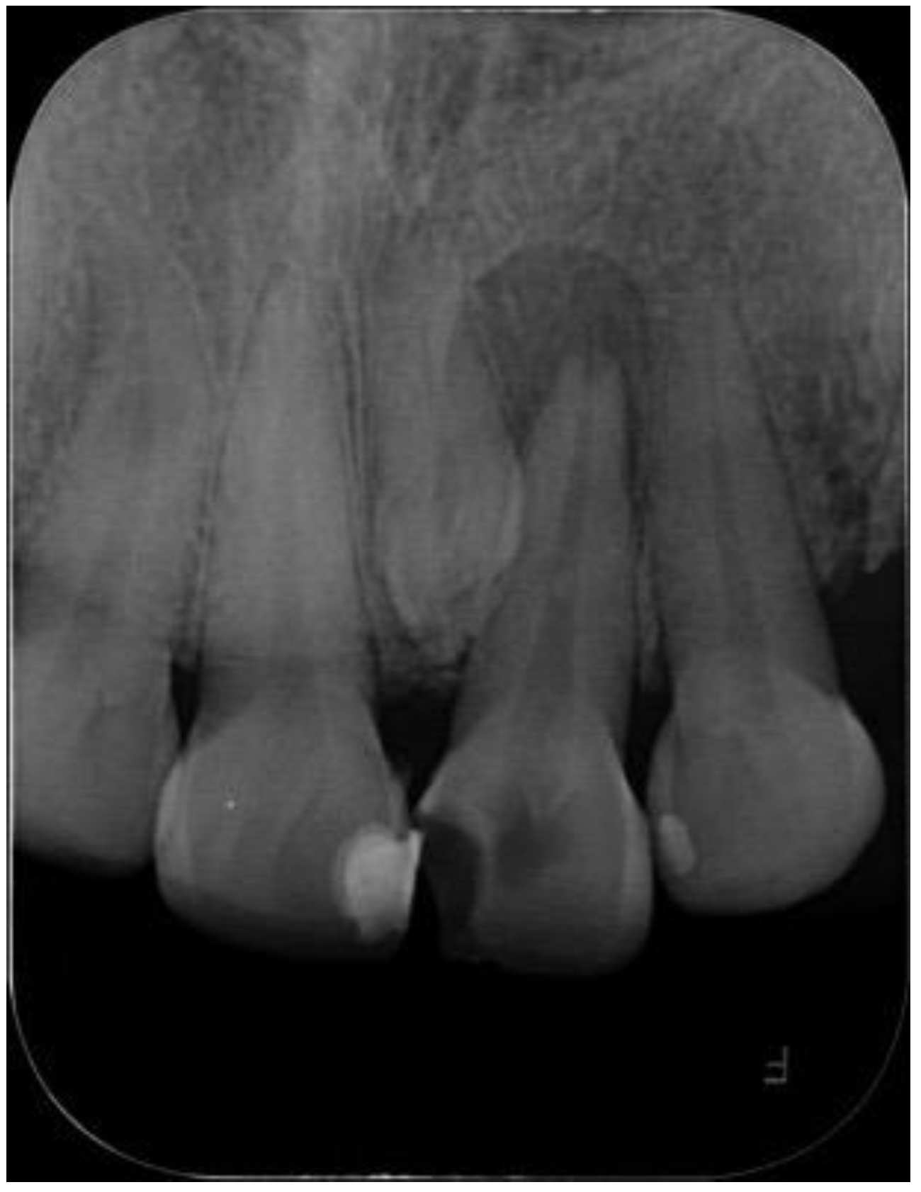 Non-Syndromic Familial Mesiodens: Presentation of Three Cases