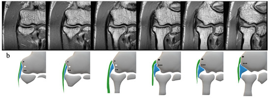 Individual Evaluation of the Common Extensor Tendon and Lateral ...