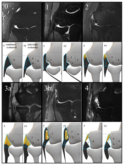 Individual Evaluation of the Common Extensor Tendon and Lateral ...