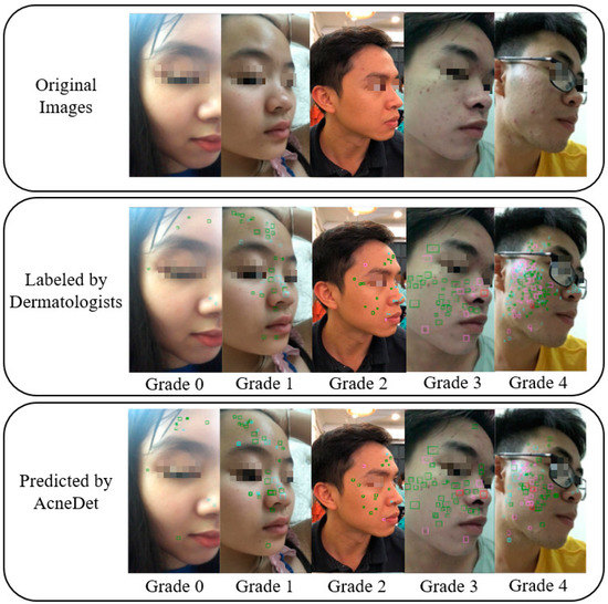 Automatic Acne Object Detection and Acne Severity Grading Using ...