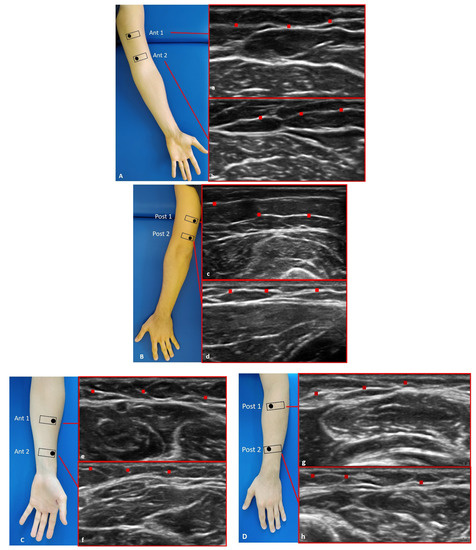 Ultrasound Imaging of the Superficial Fascia in the Upper Limb: Arm and ...