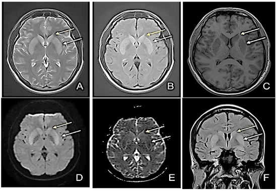 MRI Evolution of a Patient with Viral Tick-Borne Encephalitis and ...