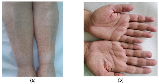 Diagnostics | Free Full-Text | Skin Dialogues in Atopic Dermatitis