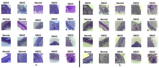 Early Diagnosis of Oral Squamous Cell Carcinoma Based on ...